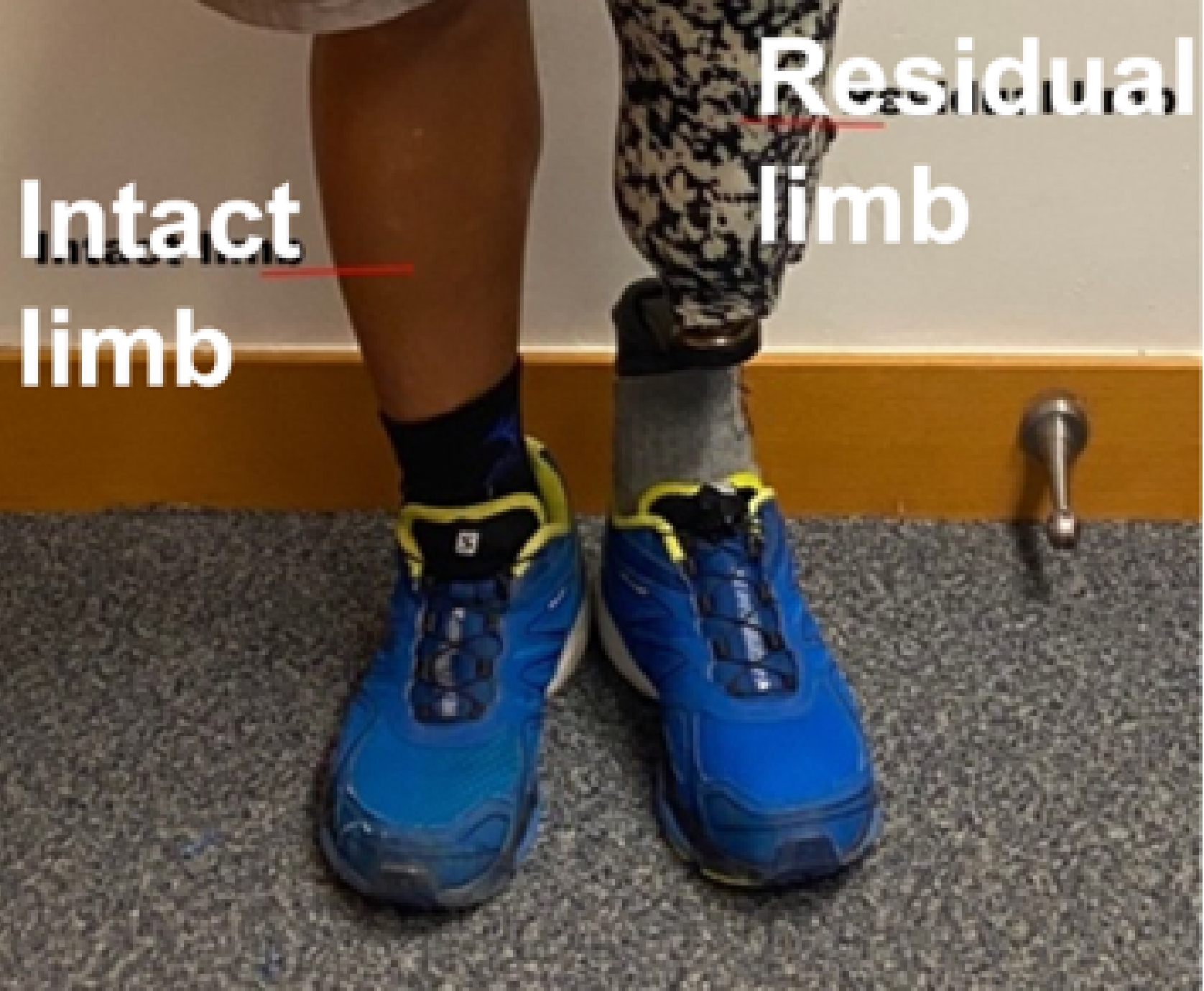 Biomechanical Analysis Of Unilateral Transtibial Amputees Using ...